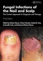 Onychoscopy of Onychomycosis | 6 | v3 | Fungal Infections of the Nail
